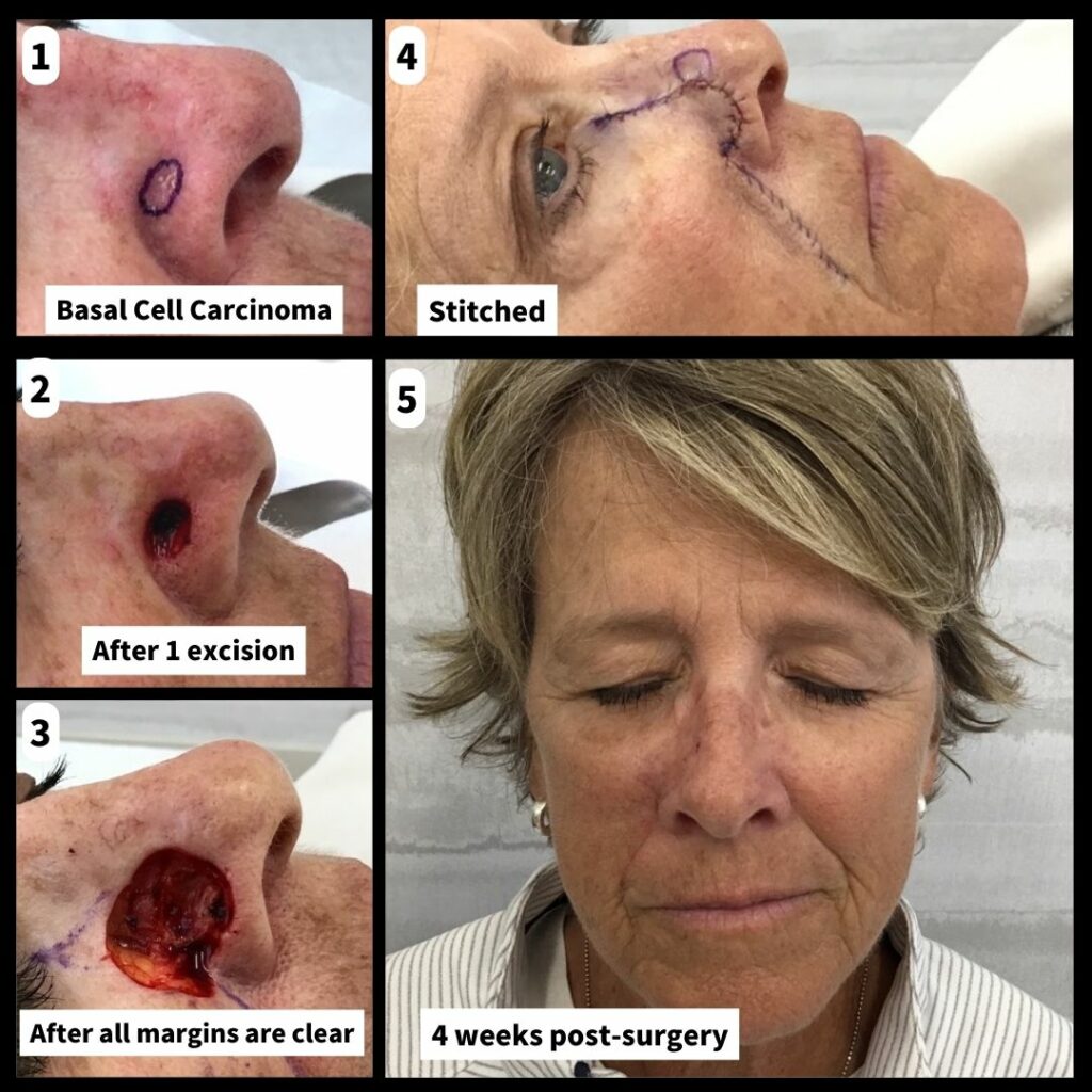 Basal Cell Carcinoma Skin Cancer Reparied Surgery With Minimal