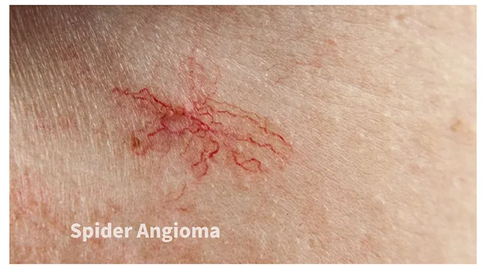 Minimally Invasive Laser Treatment | Ada West Dermatology